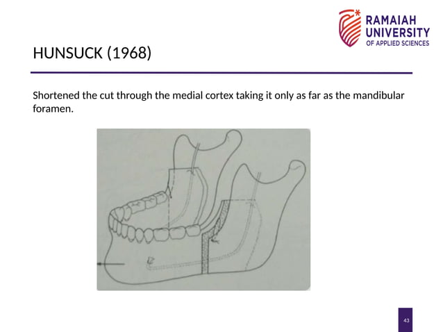 MANDIBULAR PROCEDURES INCLUDING GENIOPLASTY (2).pptx