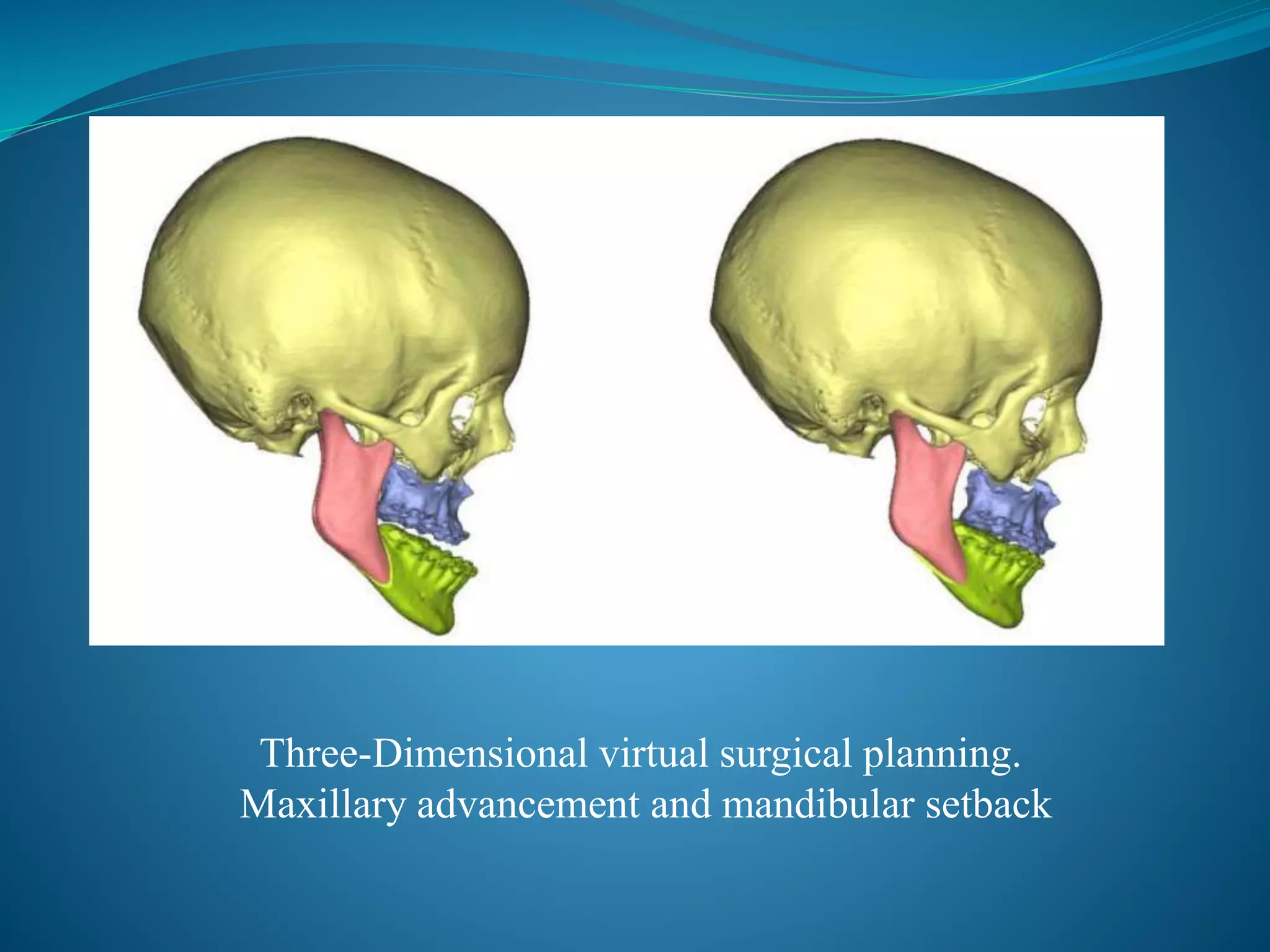 Mandibular prognathism | PPTX | Dental Health | Diseases and Conditions