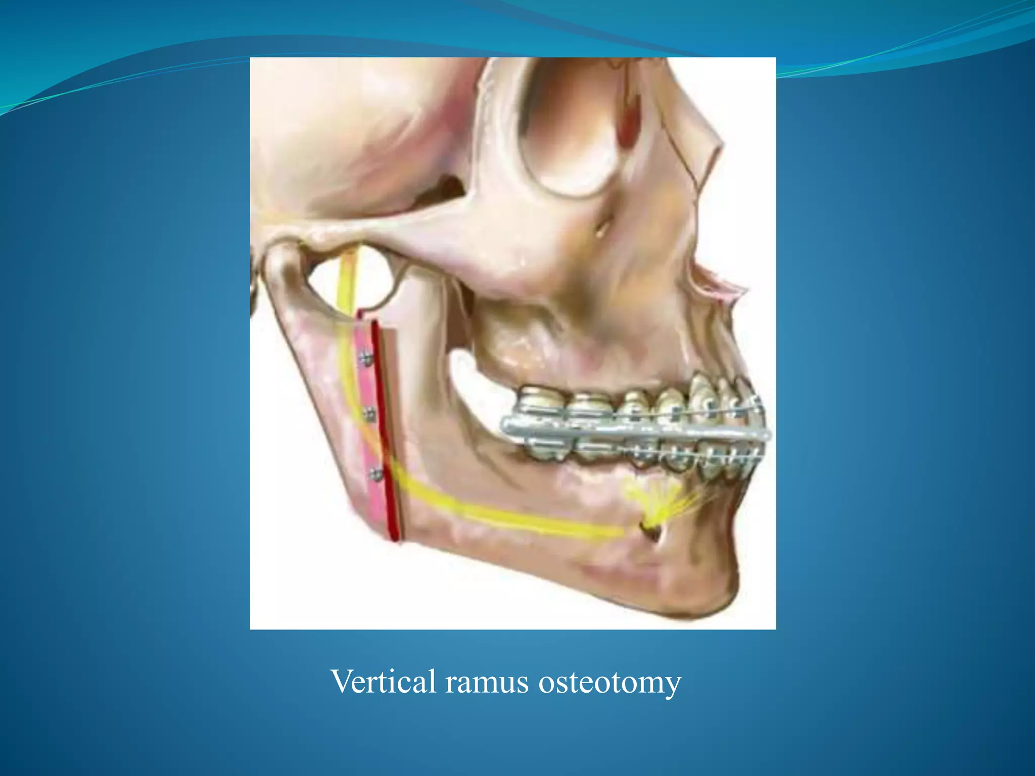 Mandibular prognathism | PPTX