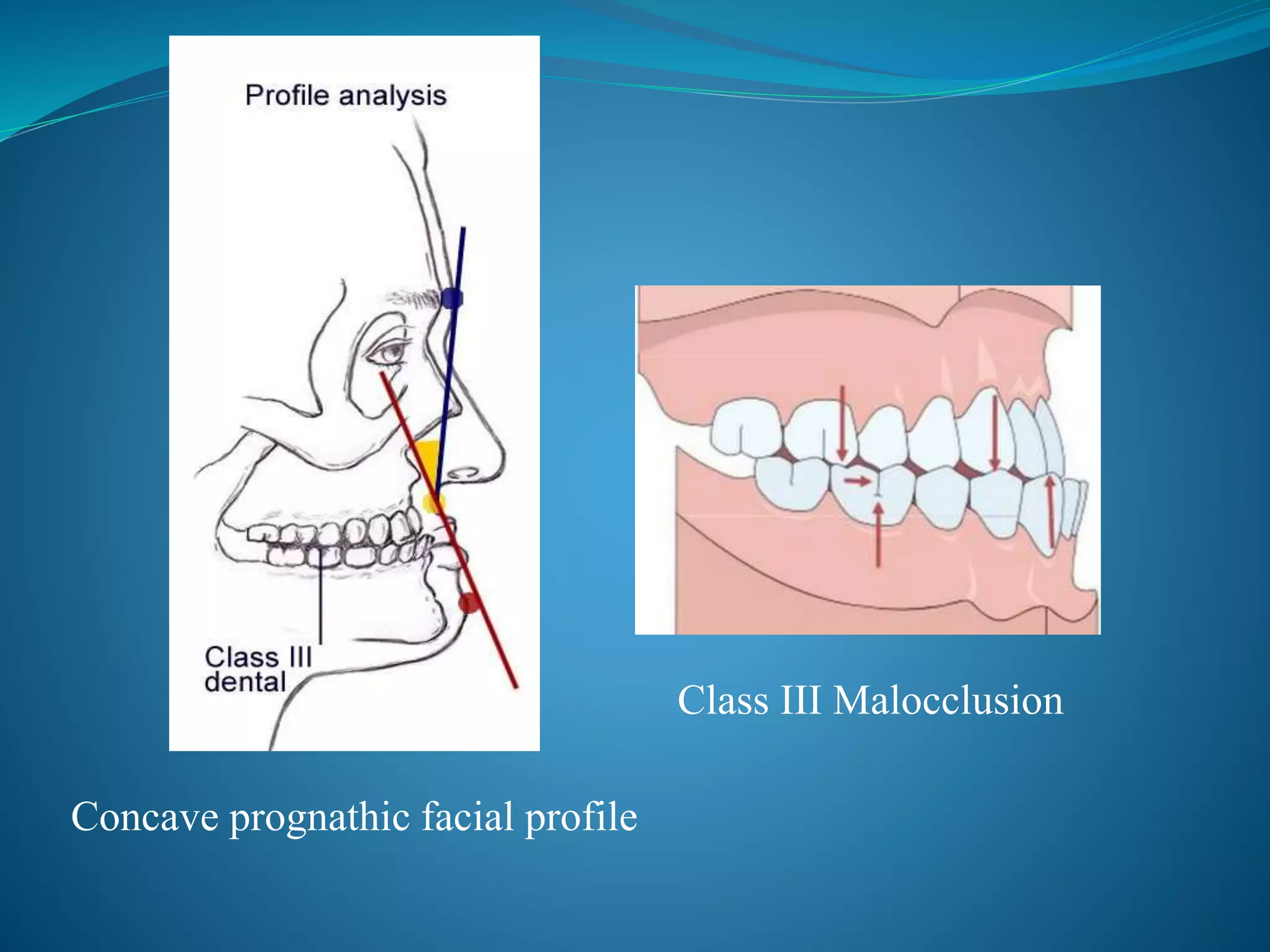 Mandibular prognathism | PPTX