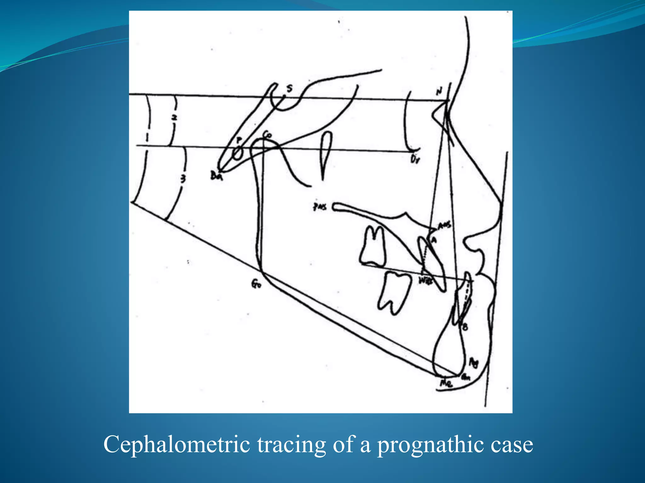 Mandibular prognathism | PPTX