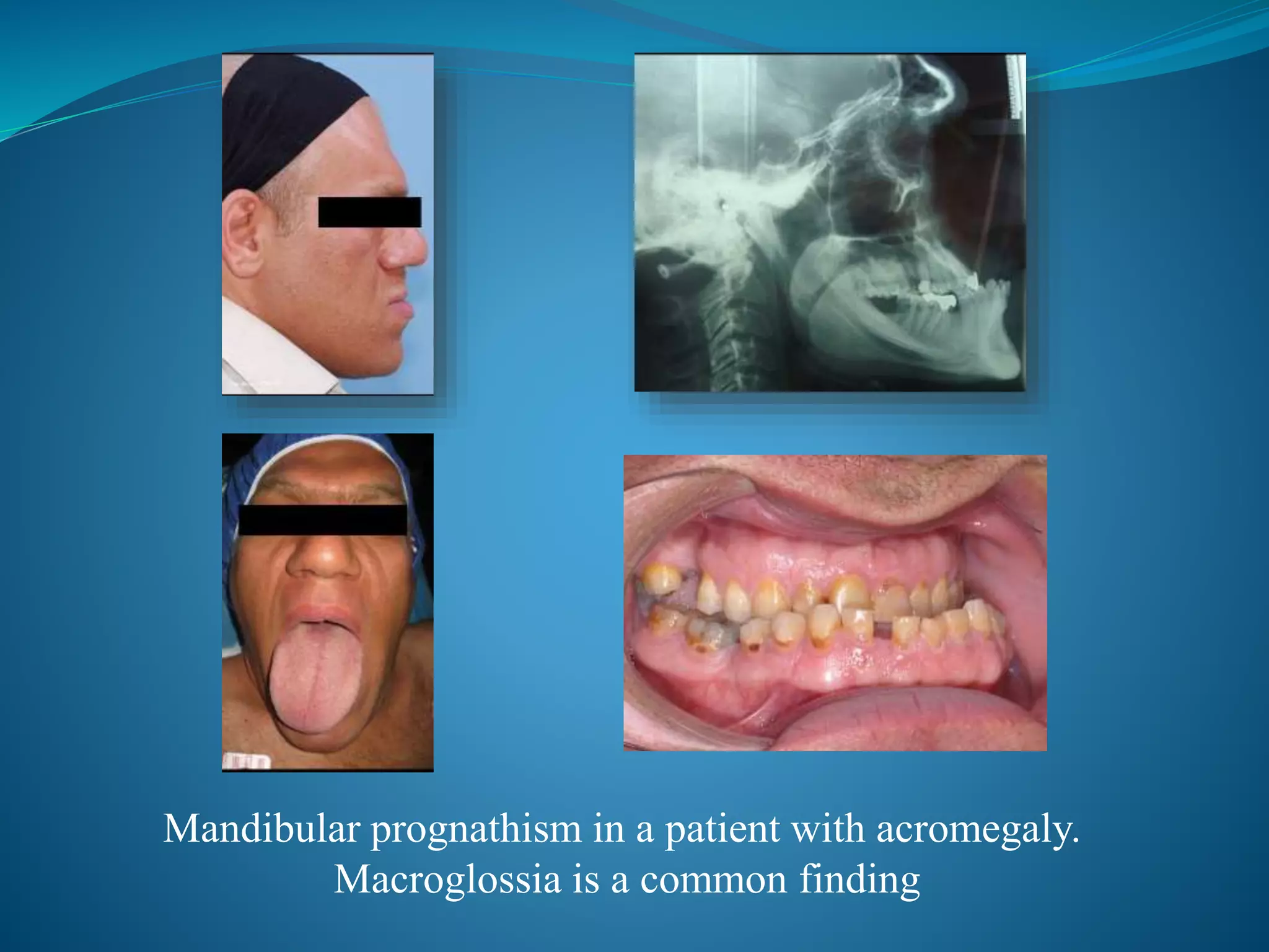 Mandibular prognathism | PPTX