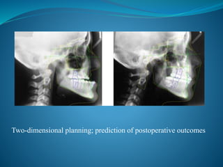 Mandibular Prognathism Radiology