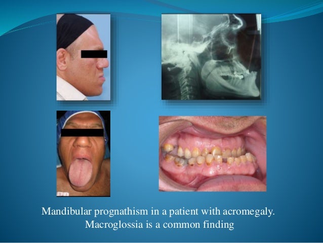 Mandibular prognathism