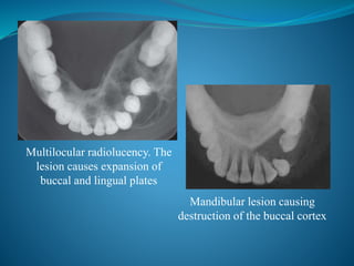 Mandibular Radiolucencies; A Systematic Approach to Diagnosis | PPTX