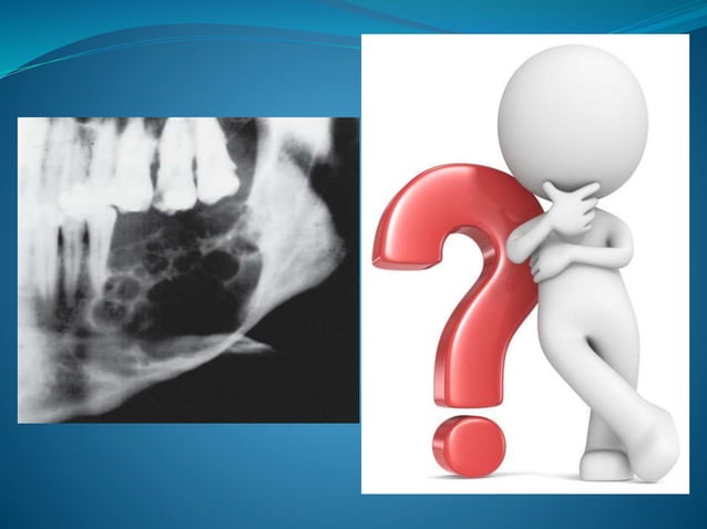 Mandibular Radiolucencies; A Systematic Approach to Diagnosis | PPTX ...