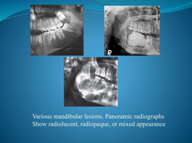 Mandibular Radiolucencies; A Systematic Approach to Diagnosis | PPTX ...