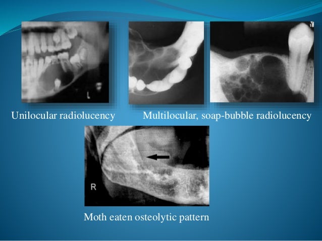 Mandibular Radiolucencies; A Systematic Approach to Diagnosis