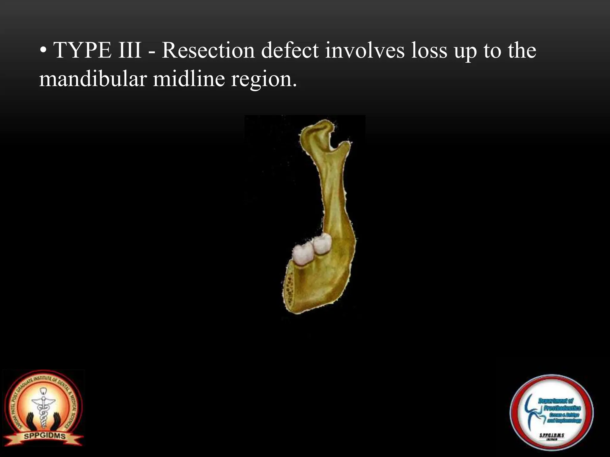 mandibular recnstruction.ppt