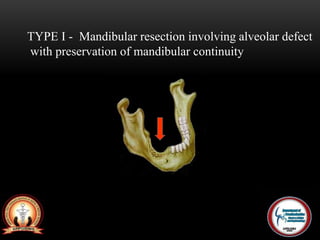 mandibular recnstruction.ppt