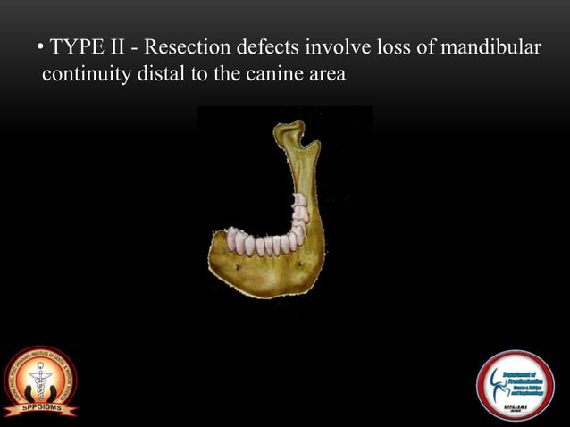mandibular recnstruction.ppt