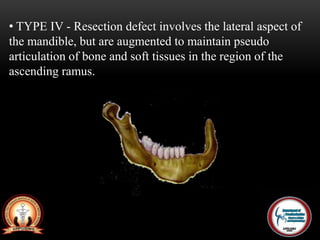mandibular recnstruction.ppt