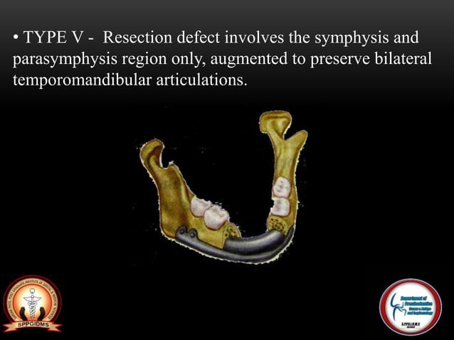 mandibular recnstruction.ppt