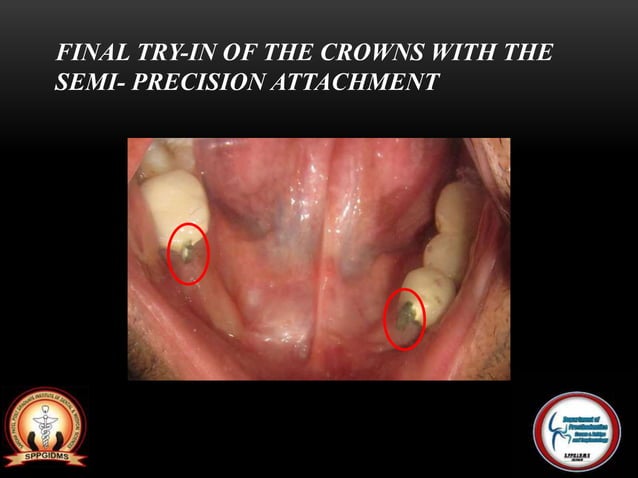 mandibular recnstruction.ppt