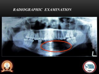 mandibular recnstruction.ppt