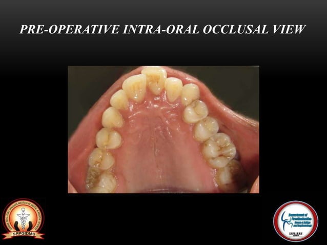 mandibular recnstruction.ppt