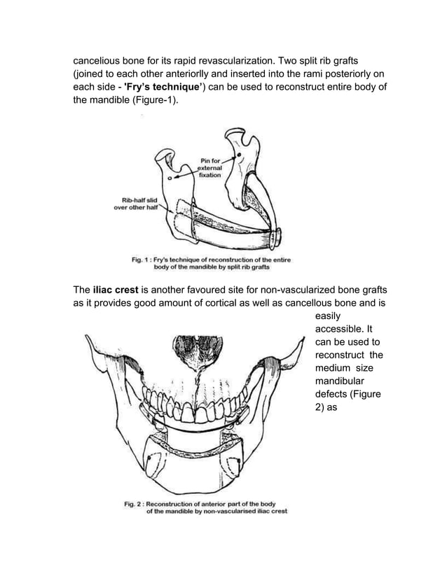 Mandibular reconstruction | DOCX | Death, Injury, or Military Conflict ...