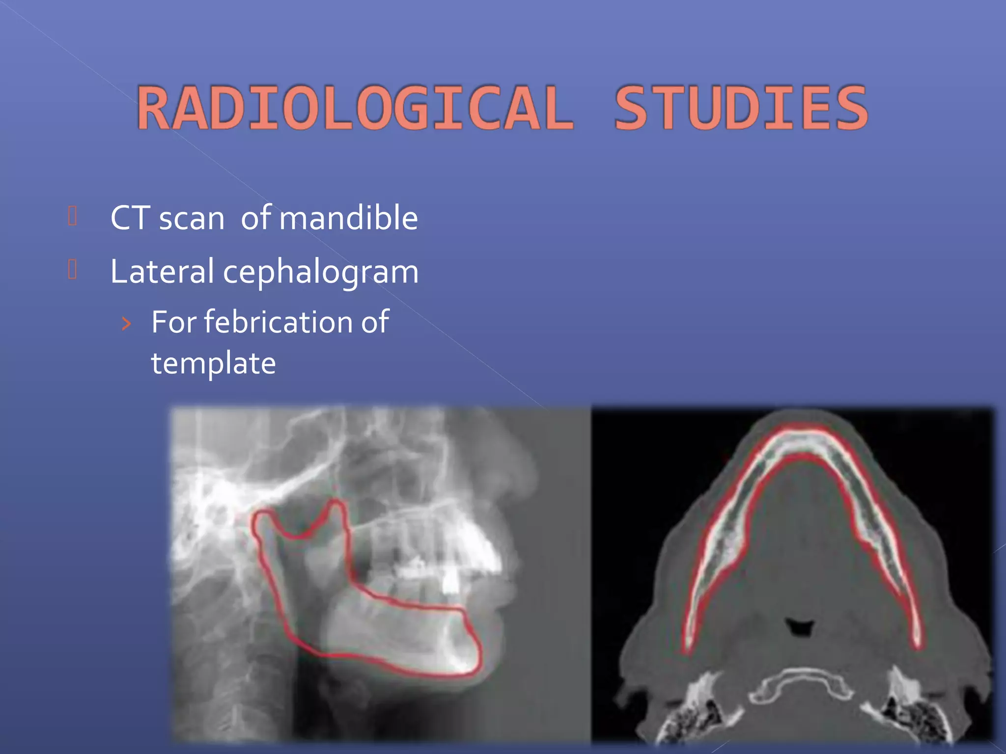 Mandibular reconstruction | PPT