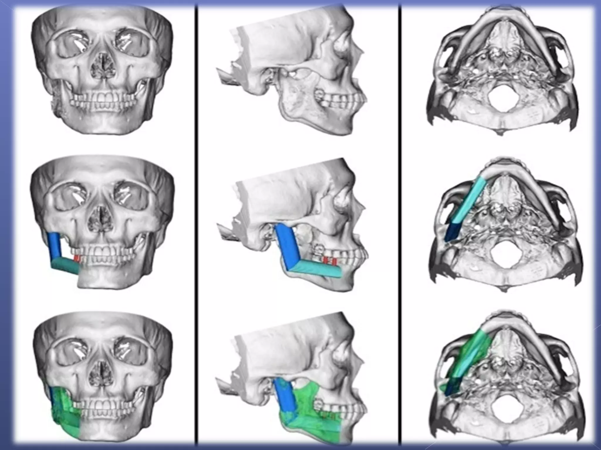 Mandibular reconstruction | PPT