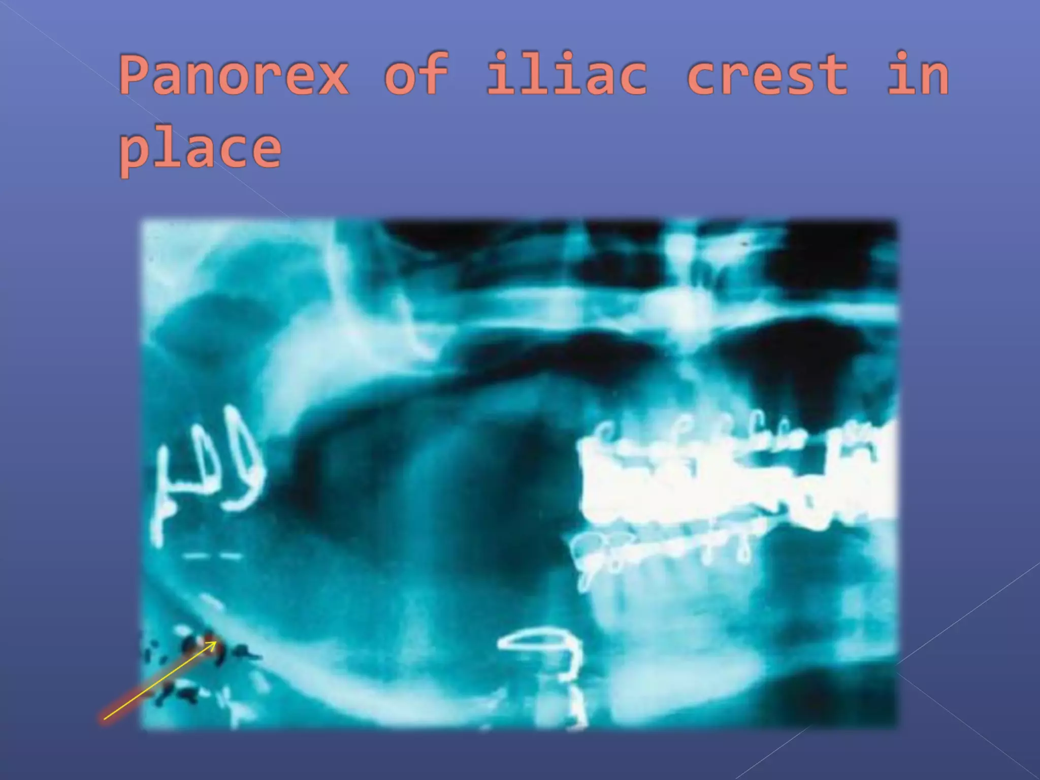 Mandibular reconstruction | PPT