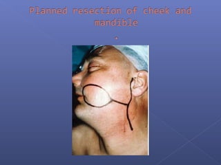Mandibular reconstruction | PPT