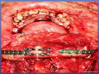 Mandibular reconstruction | PPT