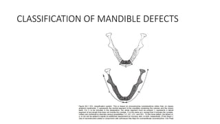 Mandibular Reconstruction. Basics of management | PPT