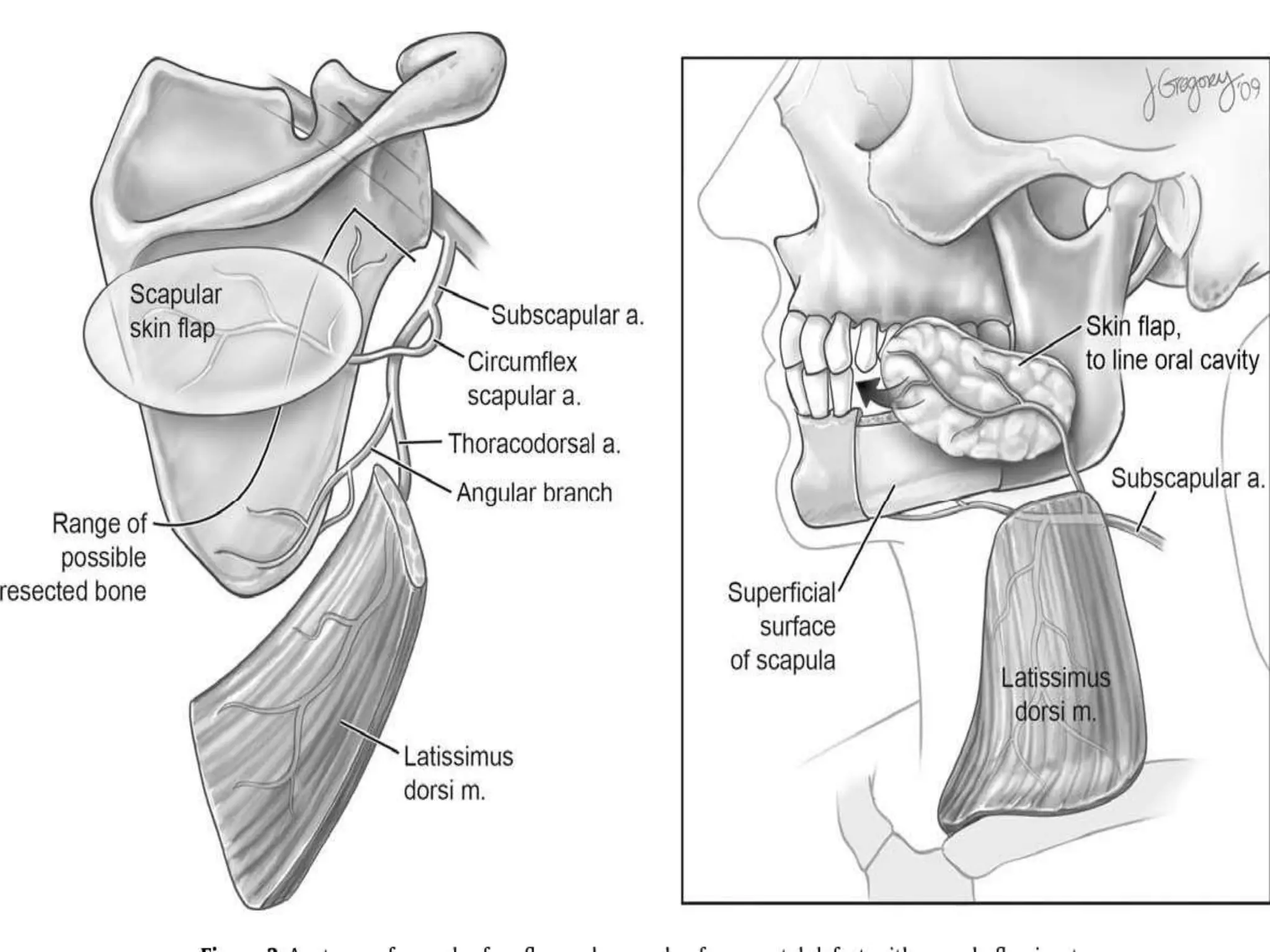 Mandibular reconstruction | PPTX
