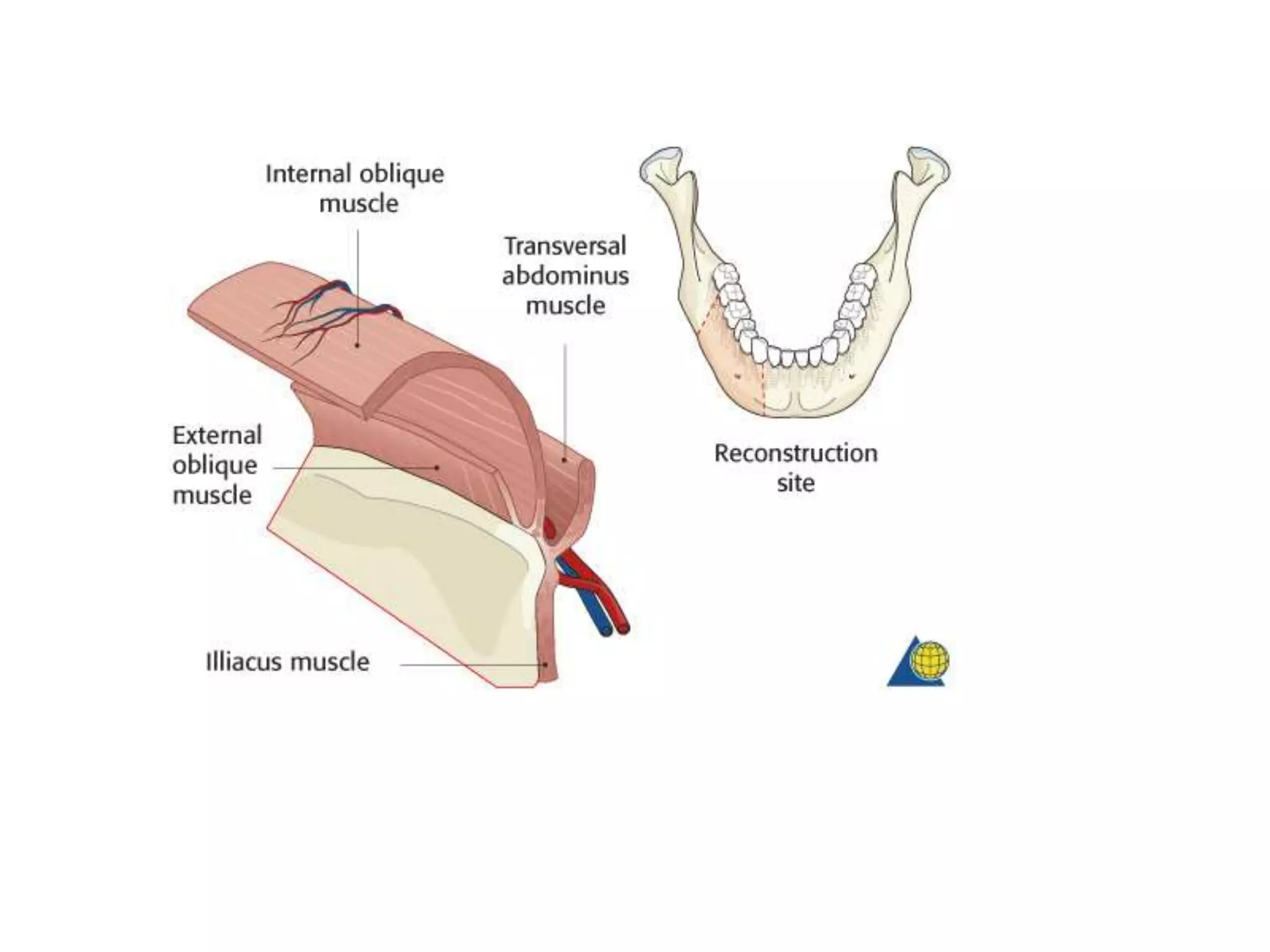 Mandibular reconstruction | PPTX