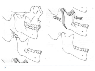 Mandibular remodelling | PPTX