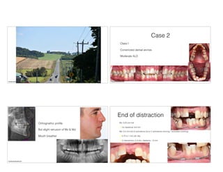 Mandibular Symphyseal Distraction Osteogenesis and SARPE aao 2018 ...