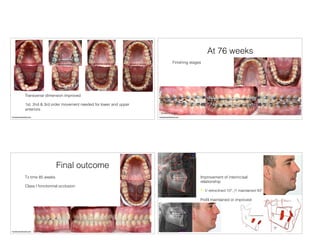 Mandibular Symphyseal Distraction Osteogenesis and SARPE aao 2018 ...