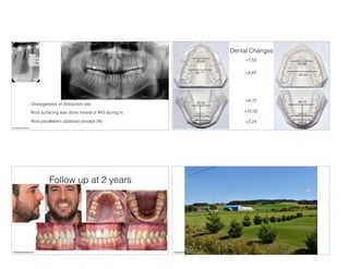 Mandibular Symphyseal Distraction Osteogenesis and SARPE aao 2018 ...