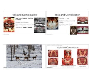 Mandibular Symphyseal Distraction Osteogenesis and SARPE aao 2018 ...