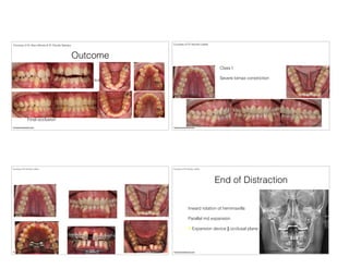 Mandibular Symphyseal Distraction Osteogenesis and SARPE aao 2018 ...