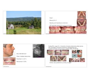 Mandibular Symphyseal Distraction Osteogenesis and SARPE aao 2018 ...