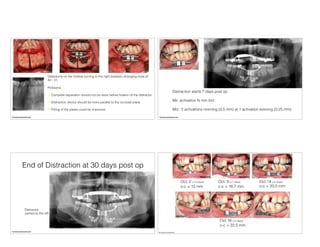 Mandibular Symphyseal Distraction Osteogenesis and SARPE aao 2018 ...