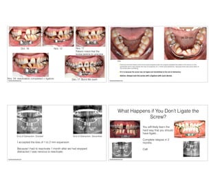 Mandibular Symphyseal Distraction Osteogenesis and SARPE aao 2018 ...