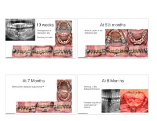 Mandibular Symphyseal Distraction Osteogenesis and SARPE aao 2018 ...