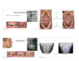 Mandibular Symphyseal Distraction Osteogenesis and SARPE aao 2018 ...
