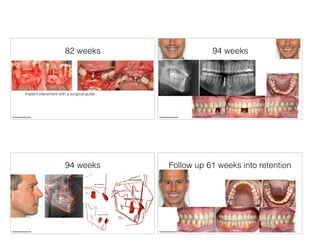 Mandibular Symphyseal Distraction Osteogenesis and SARPE aao 2018 ...