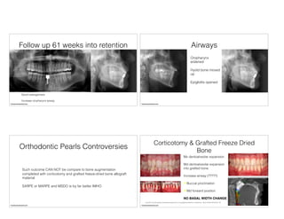 Mandibular Symphyseal Distraction Osteogenesis and SARPE aao 2018 ...