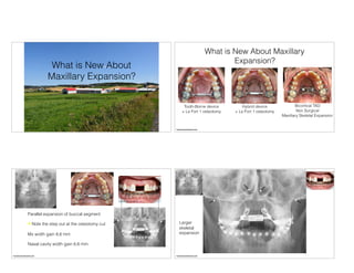 Mandibular Symphyseal Distraction Osteogenesis and SARPE aao 2018 ...