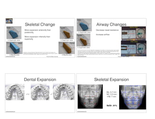 Mandibular Symphyseal Distraction Osteogenesis and SARPE aao 2018 ...