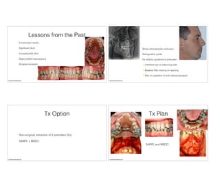 Mandibular Symphyseal Distraction Osteogenesis and SARPE aao 2018 ...