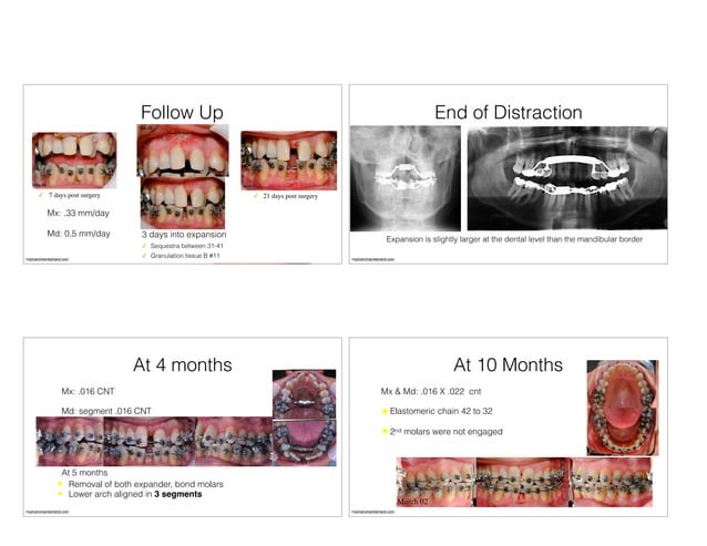 Mandibular Symphyseal Distraction Osteogenesis and SARPE aao 2018 ...