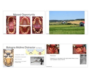 Mandibular Symphyseal Distraction Osteogenesis and SARPE aao 2018 ...