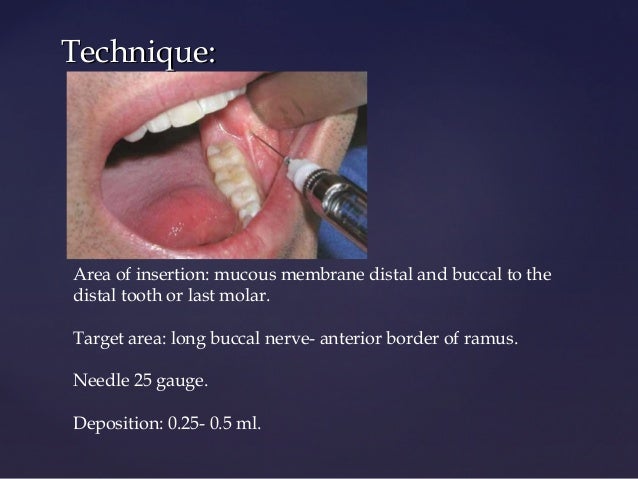 Mandibular block techniques