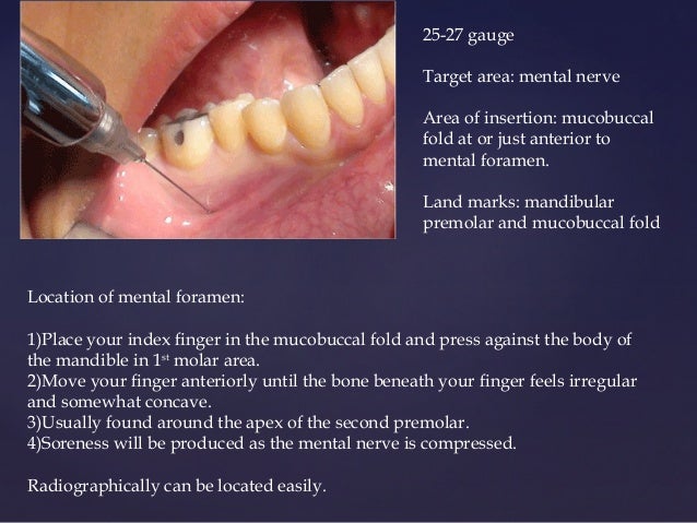 Mandibular block techniques