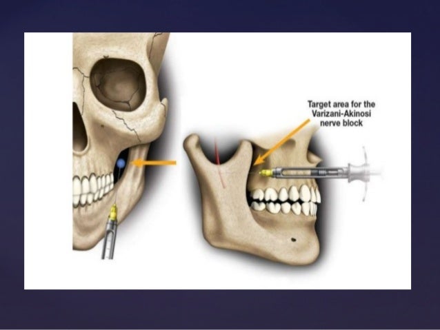 Mandibular block techniques